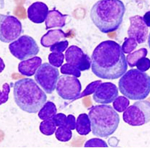 Multiple Myeloma Archives Pathology Made Simple