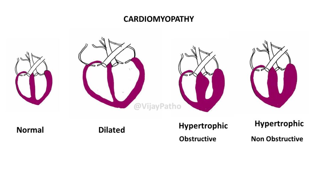 Cardiomyopathy Dilated And Hypertrophic Pathology Made Simple Cardiomyopathy Dilated And Hypertrophic Pathology Made Simple