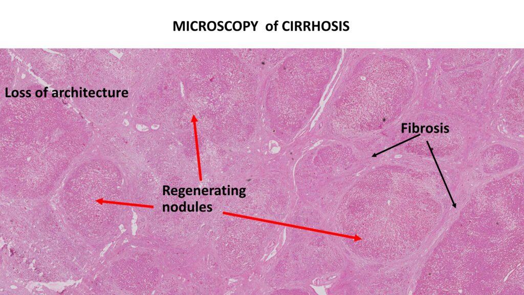 Liver Cirrhosis Histology Labeled Alcoholic Hepatitis note The