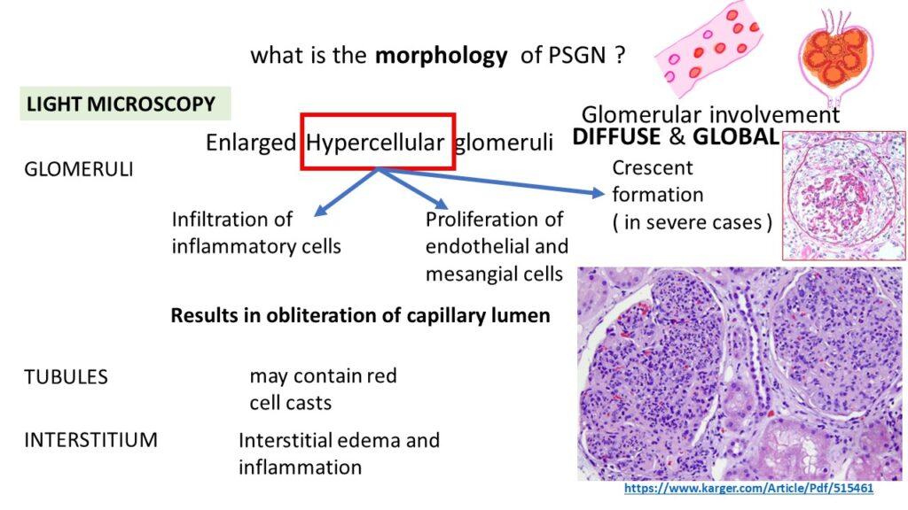 Acute Post Streptococcal Glomerulonephritis Pathology Made Simple