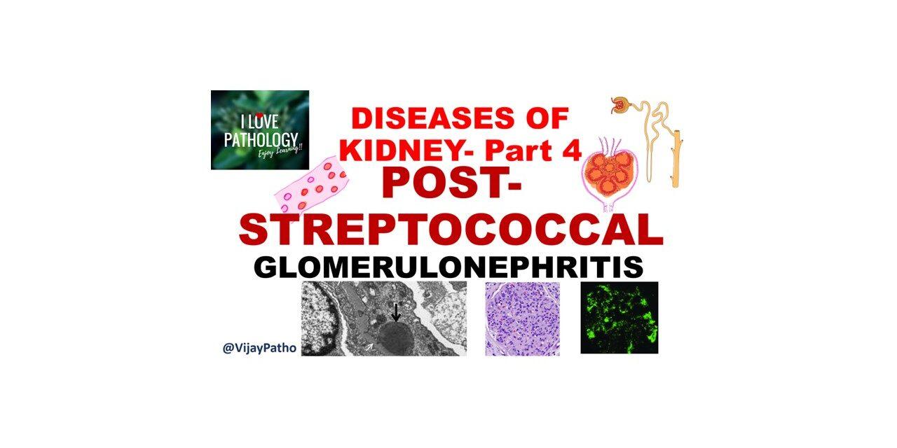 Acute Post Streptococcal Glomerulonephritis Pathology Made Simple