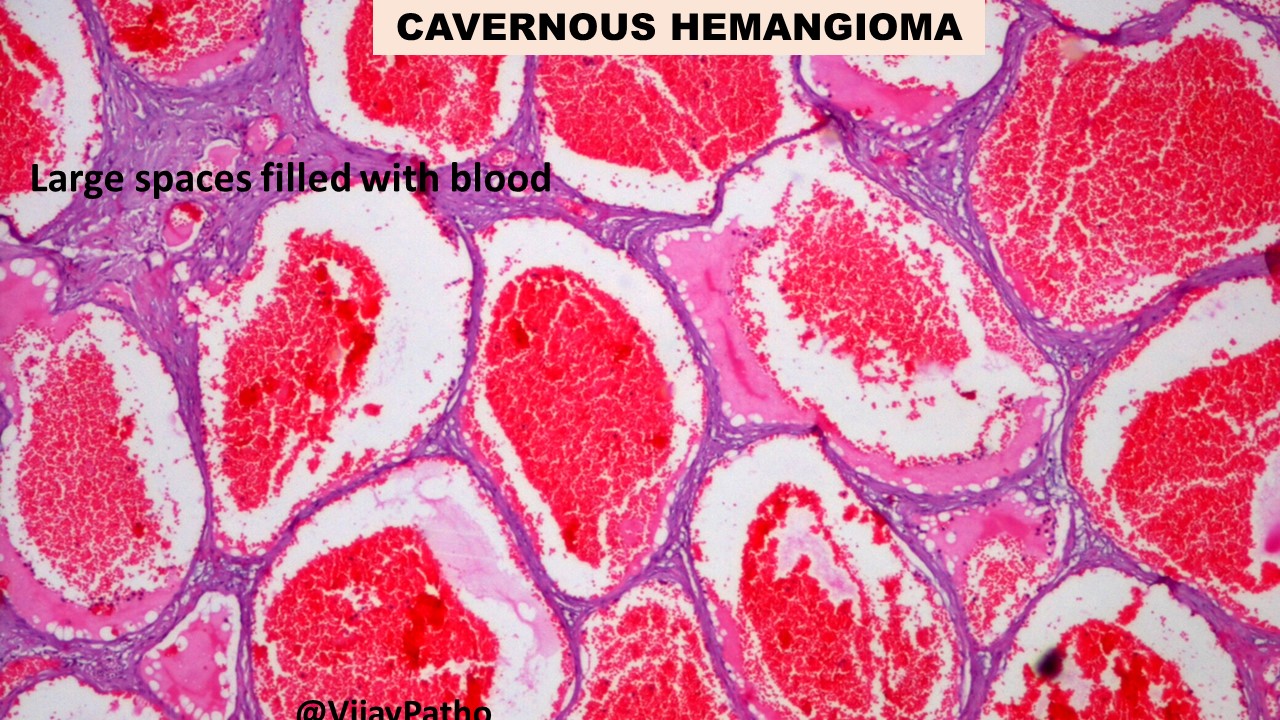 Cavernous Hemangioma - Pathology Made Simple