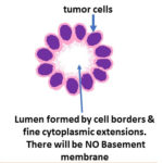 Rosettes in Pathology - Pathology Made Simple