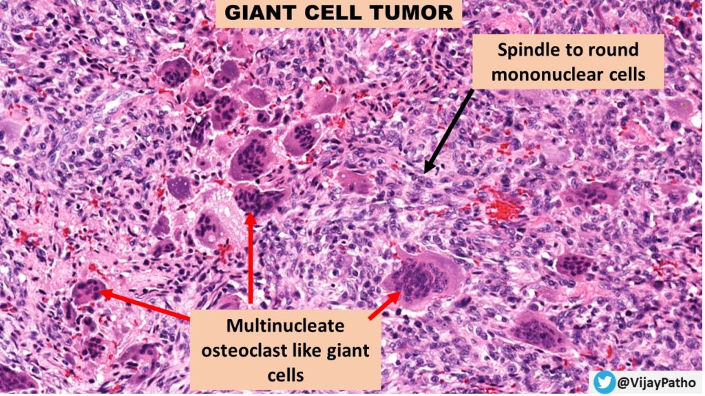 GIANT CELL TUMOR BONE Pathology Made Simple GIANT CELL TUMOR BONE Pathology Made Simple