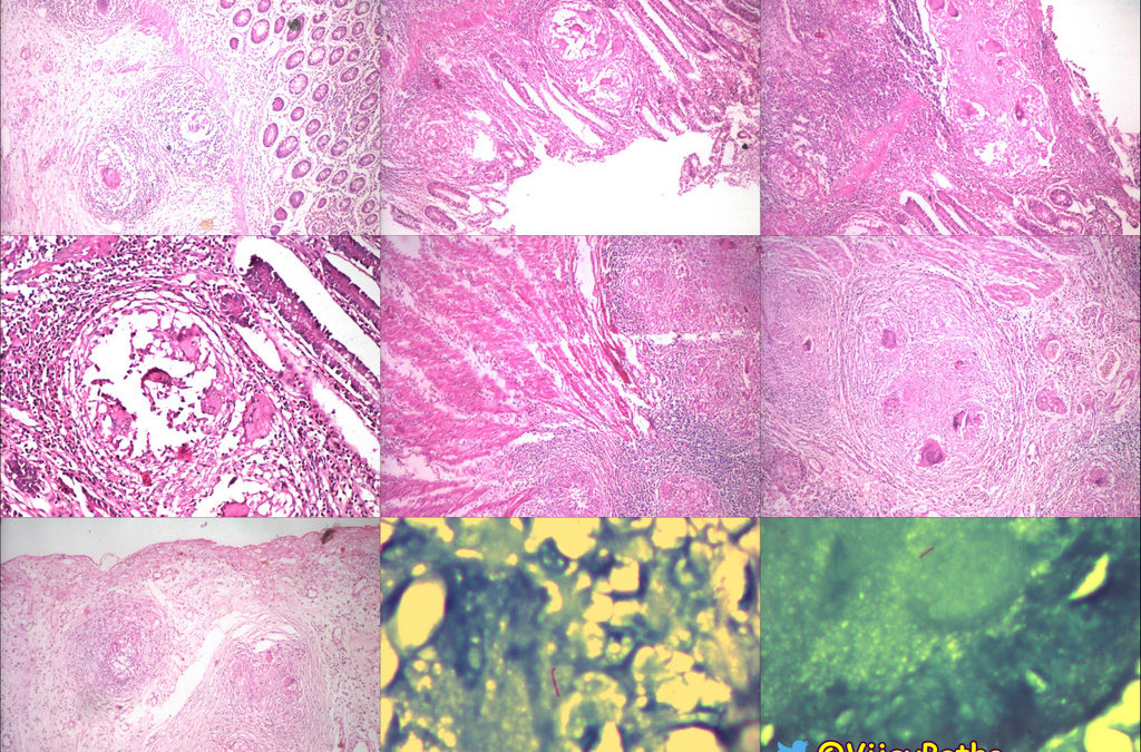 Intestinal Tuberculosis | Pathology Made Simple