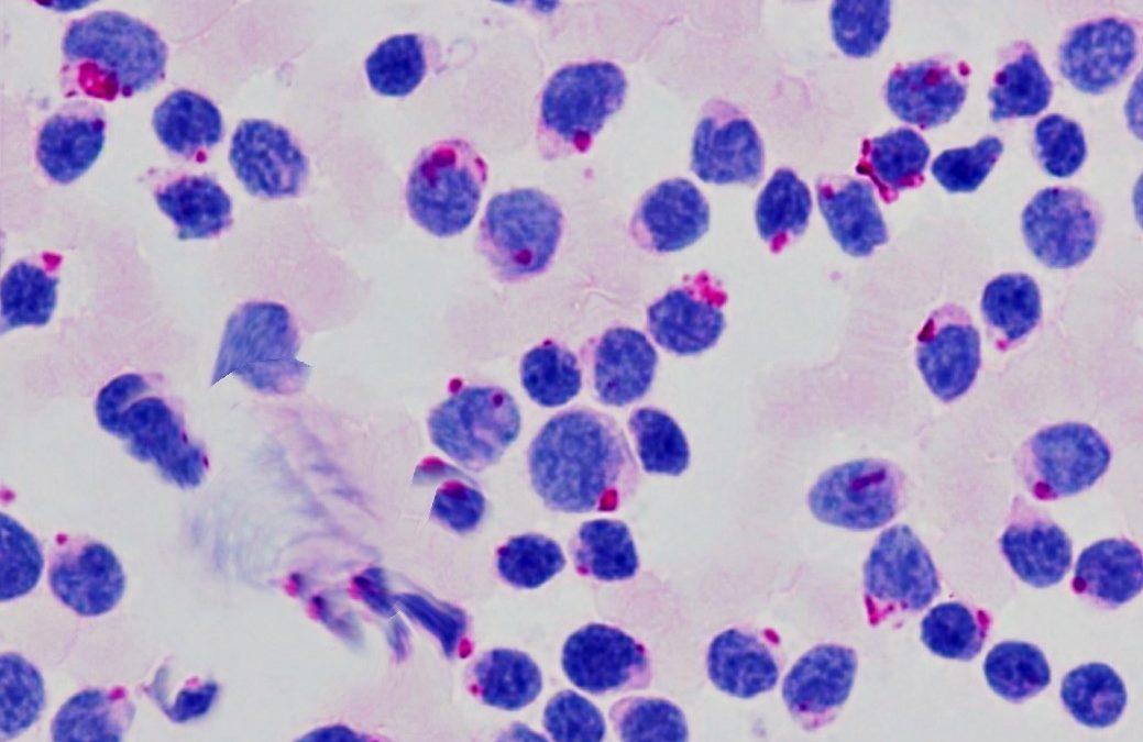 CYTOCHEMICAL STAINS IN HEMATOLOGICAL NEOPLASMS. | Pathology Made Simple