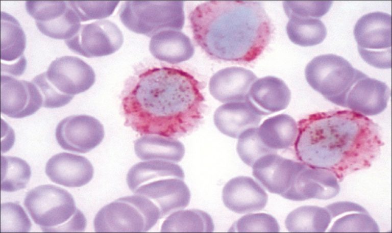 CYTOCHEMICAL STAINS IN HEMATOLOGICAL NEOPLASMS. - Pathology Made Simple