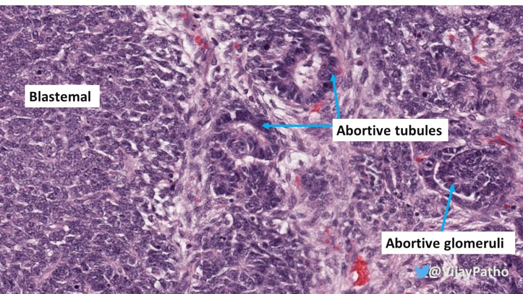 WILMS TUMOR( NEPHROBLASTOMA) - Pathology Made Simple