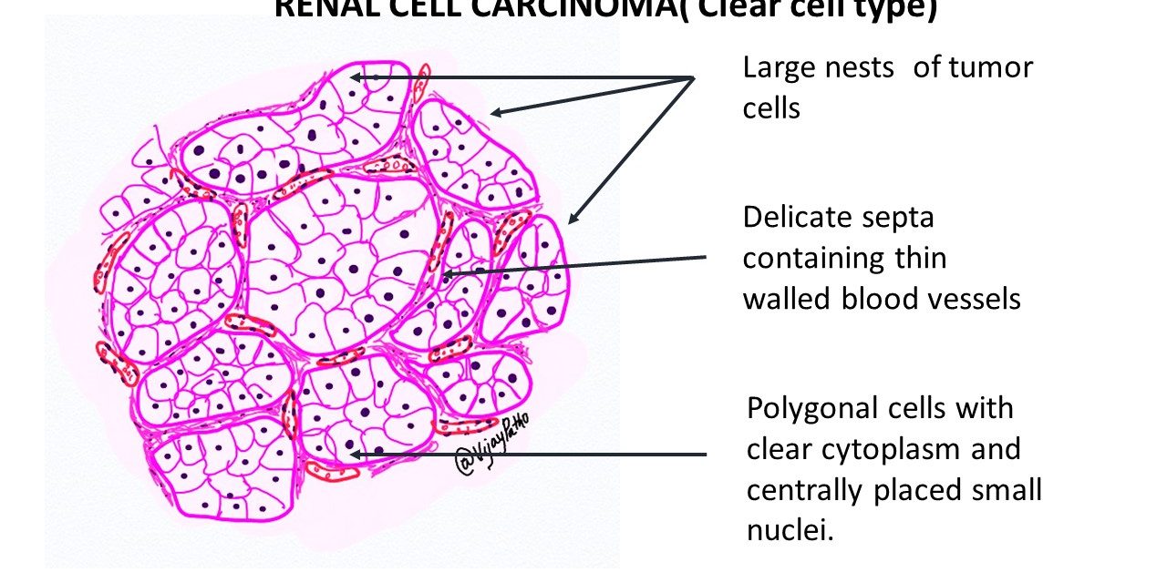 RENAL CELL CARCINOMA CLEAR CELL TYPE Pathology Made Simple RENAL CELL CARCINOMA CLEAR CELL TYPE Pathology Made Simple