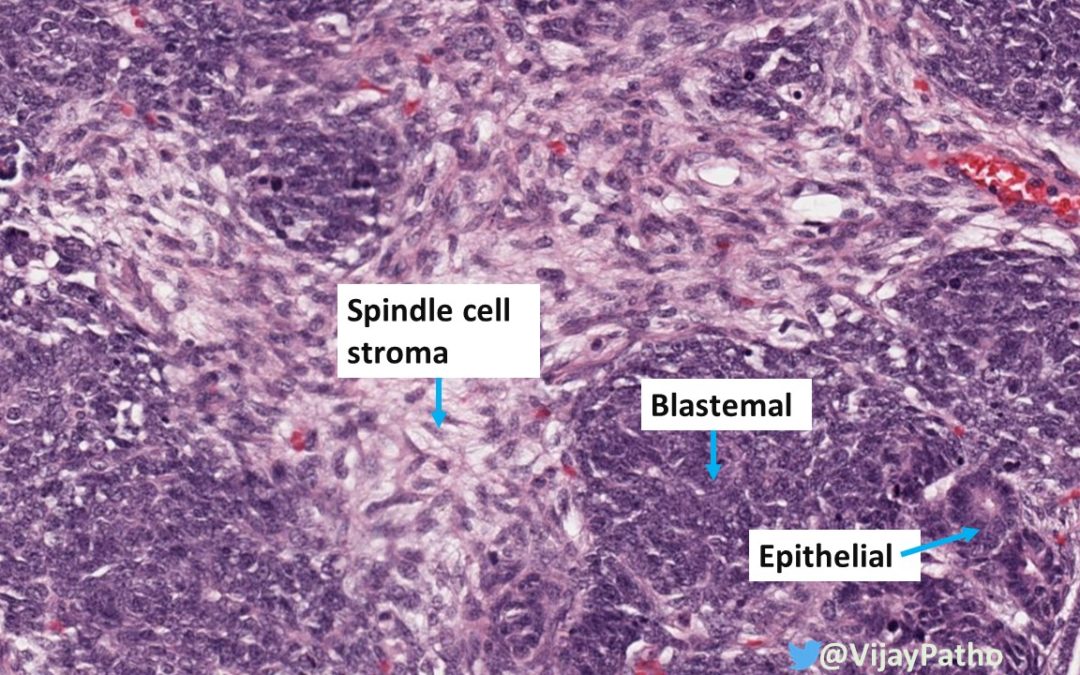 WILMS TUMOR( NEPHROBLASTOMA) | Pathology Made Simple