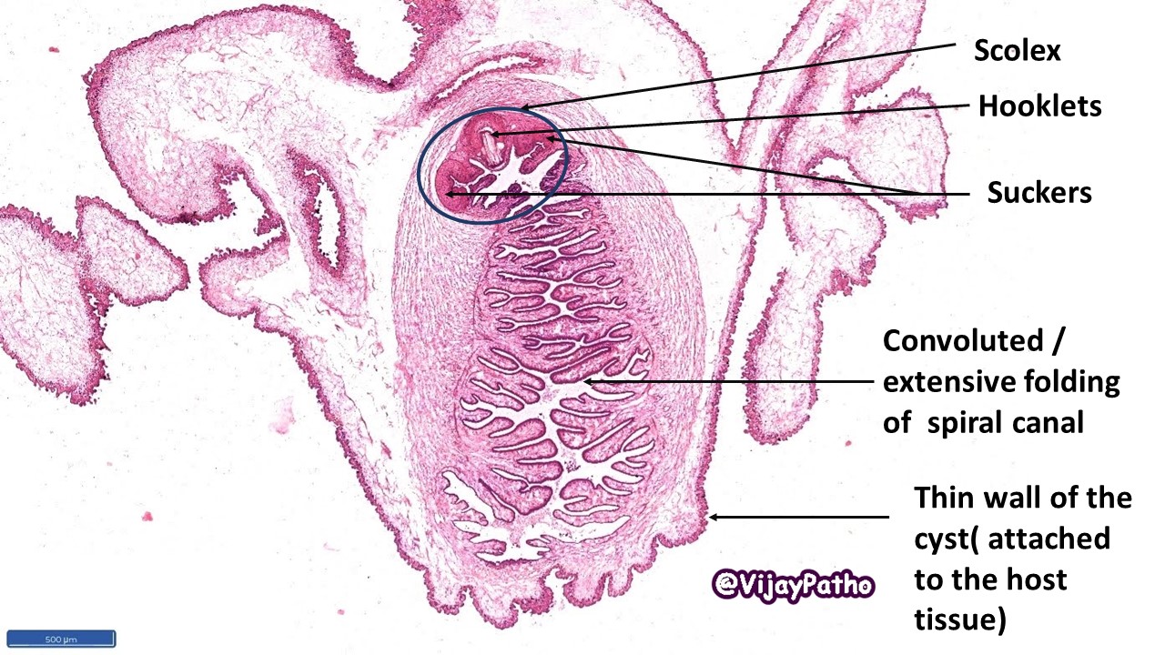 PATHOLOGY OF CYSTICERCOSIS - Pathology Made Simple