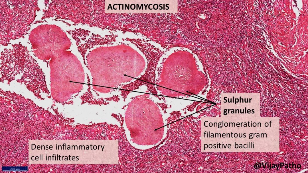ACTINOMYCOSIS - Pathology Made Simple