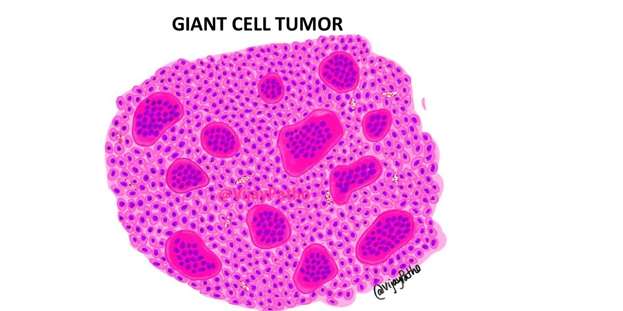 GIANT CELL TUMOR BONE Pathology Made Simple GIANT CELL TUMOR BONE Pathology Made Simple