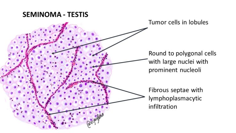 Seminoma Testis Pathology Made Simple