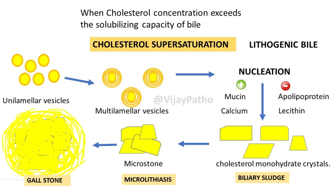 GALL STONES/CHOLELITHIASIS: pathogenesis - Pathology Made Simple