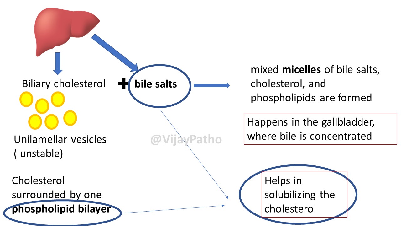 GALL STONES/CHOLELITHIASIS: pathogenesis - Pathology Made Simple