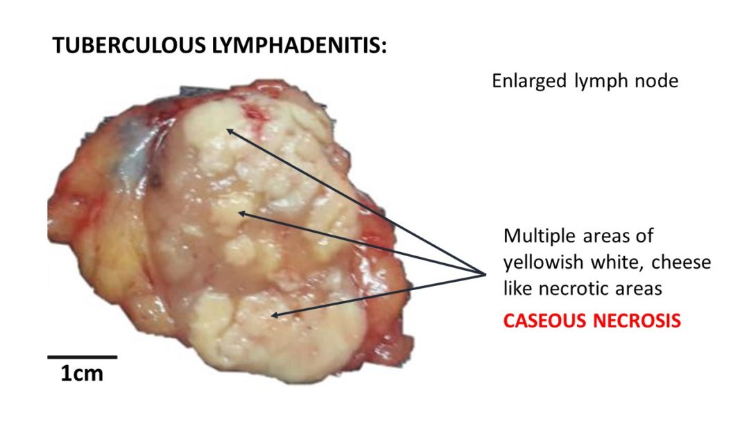 TUBERCULOUS LYMPHADENITIS - Pathology Made Simple