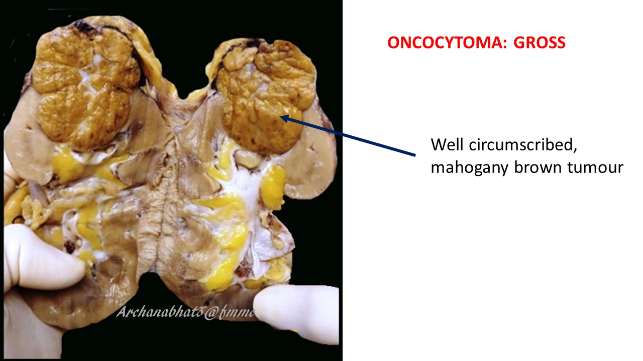 Pathology of Renal Oncocytoma - Pathology Made Simple