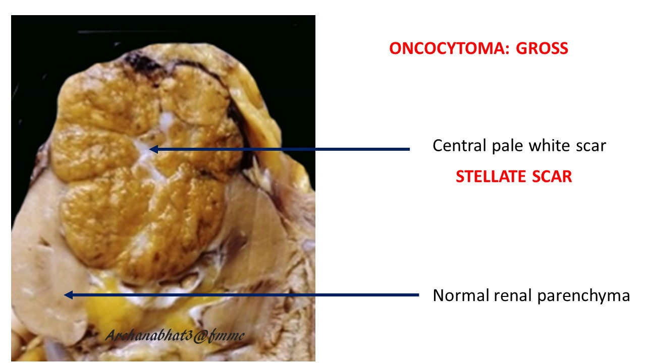 Pathology of Renal Oncocytoma - Pathology Made Simple