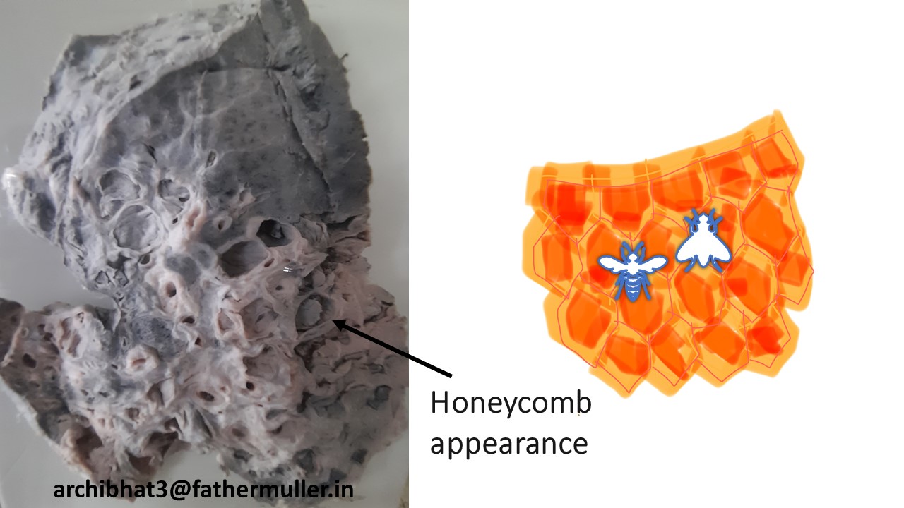 Pathology of BRONCHIECTASIS - Pathology Made Simple