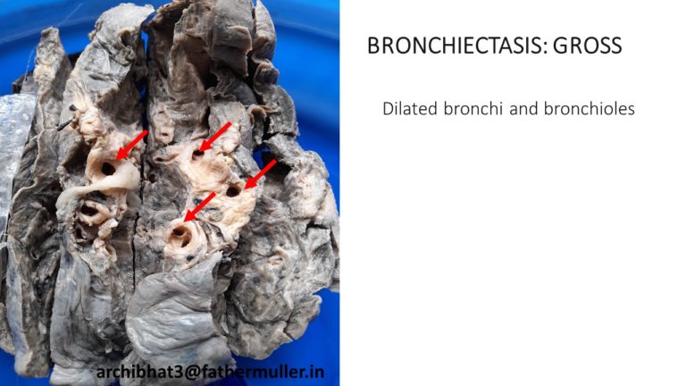 Pathology of BRONCHIECTASIS - Pathology Made Simple