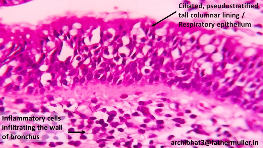 Pathology of BRONCHIECTASIS - Pathology Made Simple