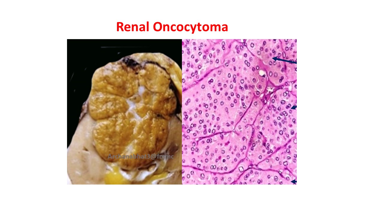 Pathology of Renal Oncocytoma - Pathology Made Simple