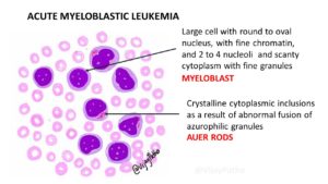 Peripheral smear findings in Leukemia - Illustrated - Pathology Made Simple