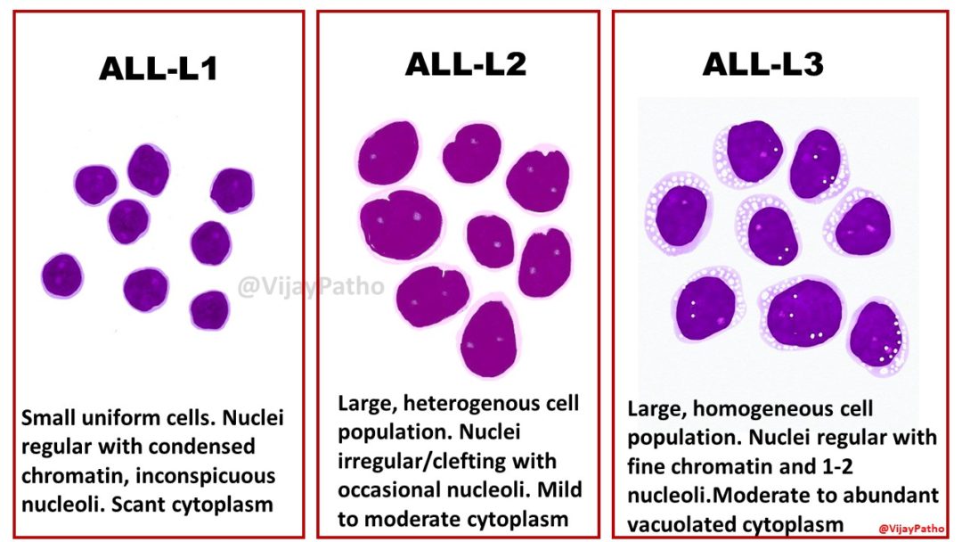Peripheral smear findings in Leukemia - Illustrated - Pathology Made Simple