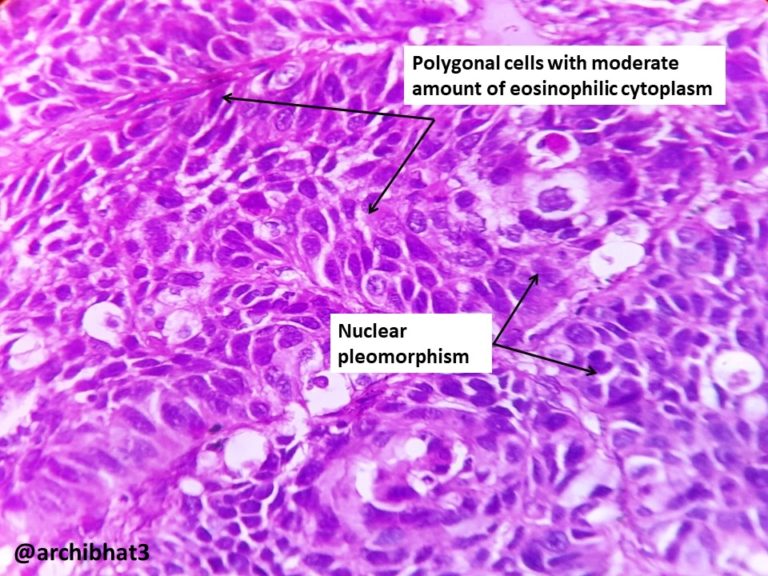 Pathology of Bronchogenic carcinoma /squamous cell carcinoma-lung ...