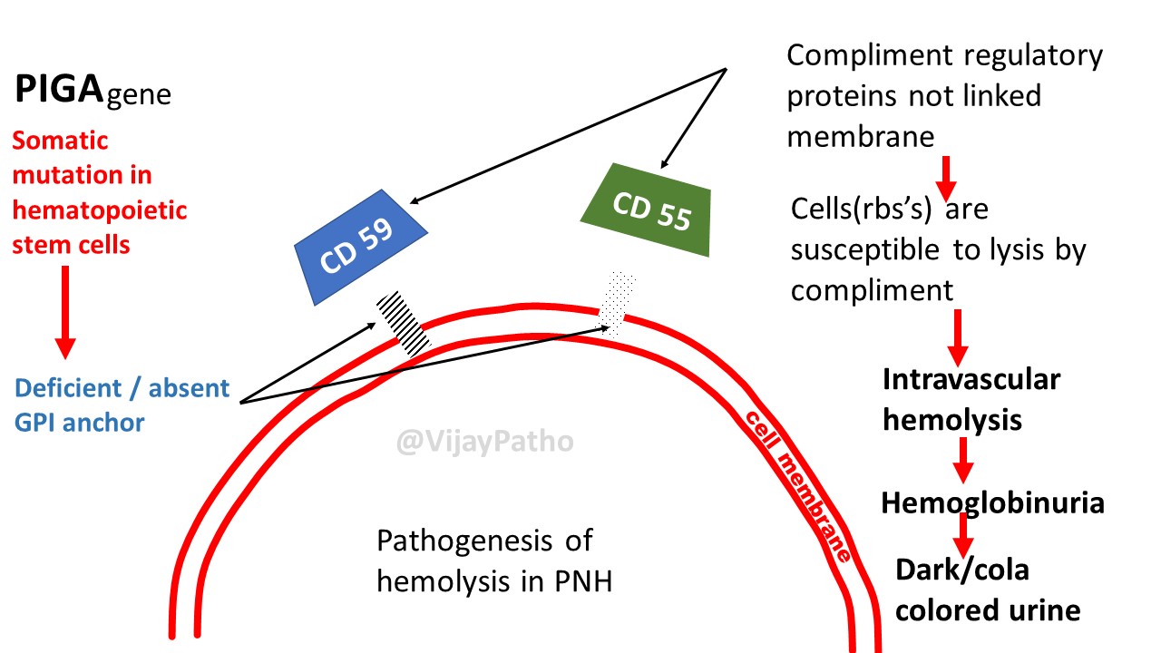 Pathology of PAROXYSMAL NOCTURNAL HEMOGLOBINURIA - Pathology Made Simple