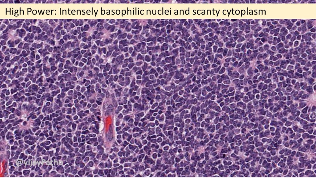 Pathology of RETINOBLASTOMA | Pathology Made Simple