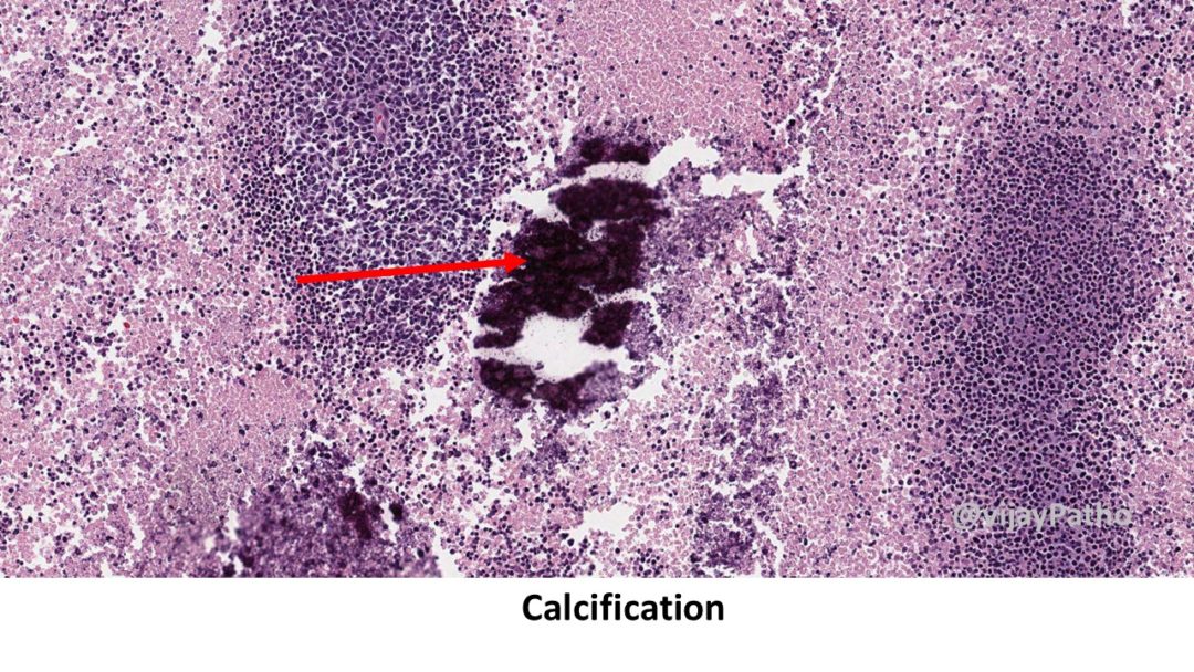 Pathology of RETINOBLASTOMA - Pathology Made Simple