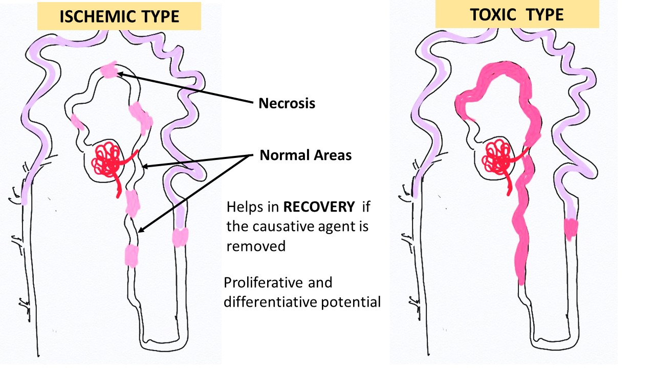 Pathology of Acute tubular injury/necrosis - Pathology Made Simple