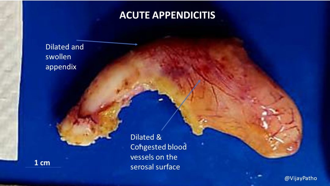 ACUTE APPENDICITIS - Pathology Made Simple