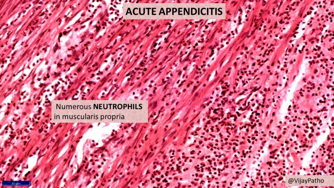ACUTE APPENDICITIS - Pathology Made Simple