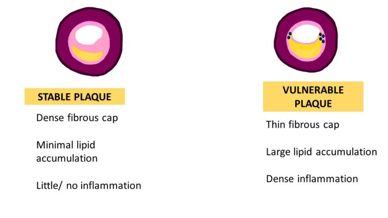 Pathology of Atherosclerosis - Pathology Made Simple