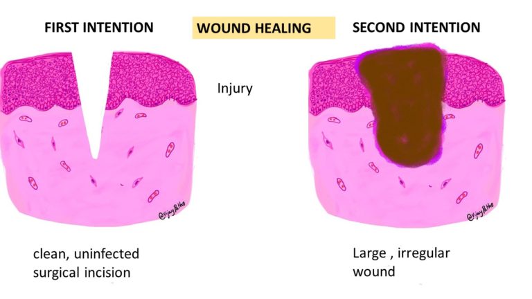 TISSUE REPAIR: Wound Healing - Pathology Made Simple