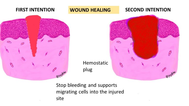 TISSUE REPAIR: Wound Healing - Pathology Made Simple