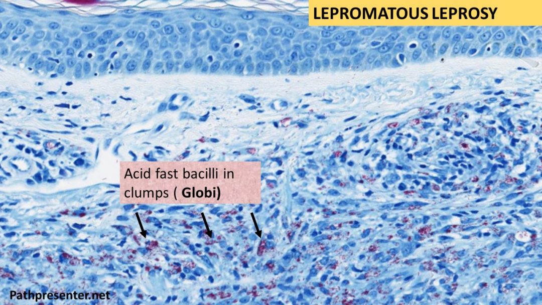 LEPROSY- Tuberculoid & Lepromatous | Pathology Made Simple