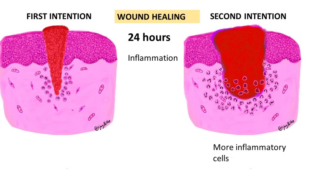 TISSUE REPAIR: Wound Healing - Pathology Made Simple