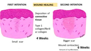 TISSUE REPAIR: Wound Healing - Pathology Made Simple
