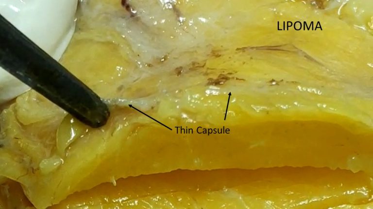 Pathology of Lipoma - Pathology Made Simple
