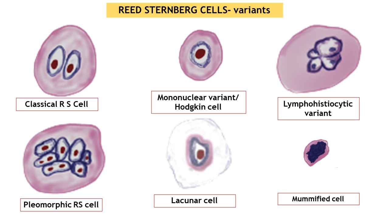 REED- STERNBERG CELLS - Pathology Made Simple