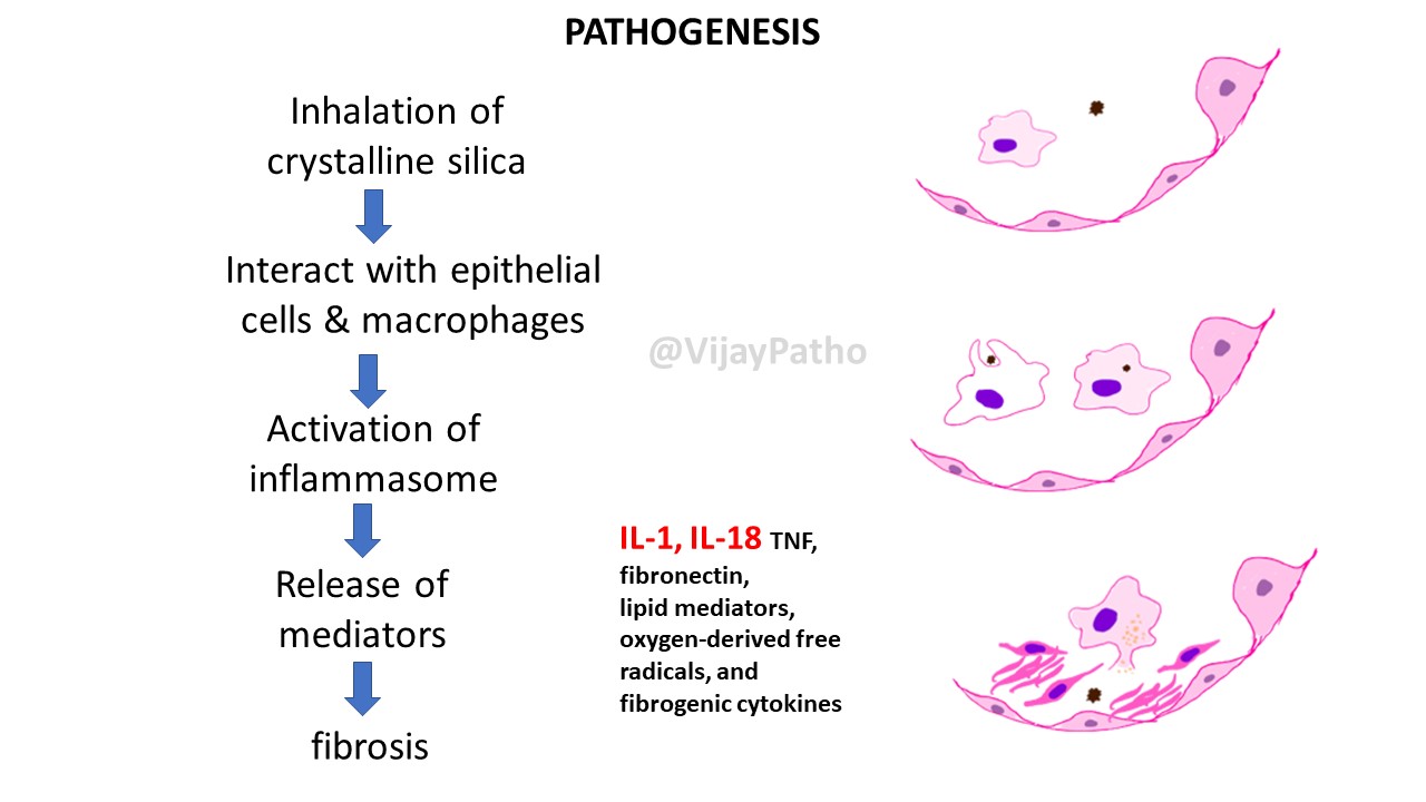 SILICOSIS - Pathology Made Simple