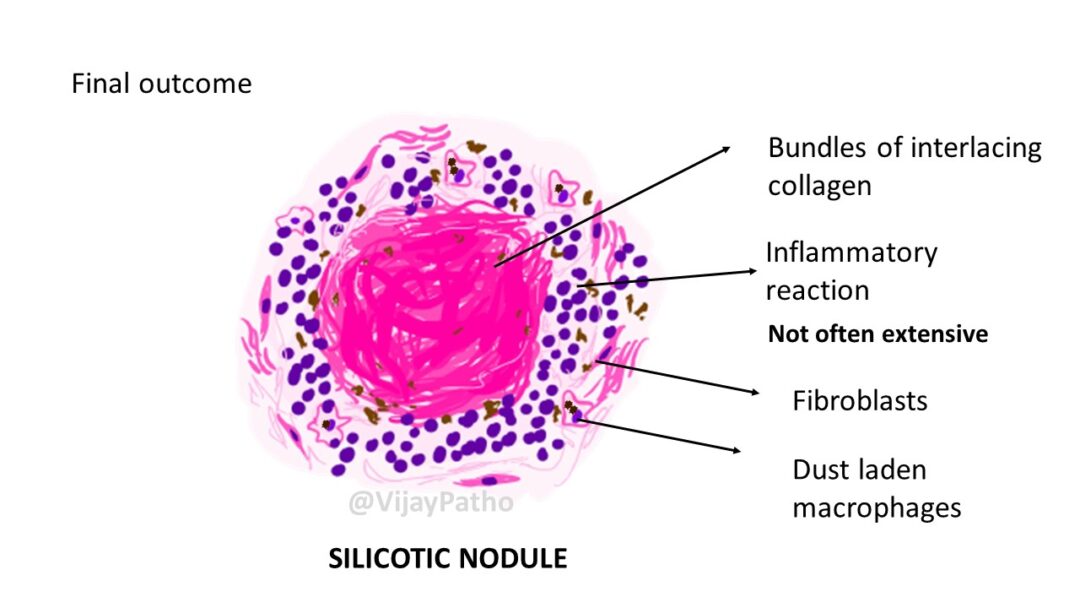 SILICOSIS - Pathology Made Simple