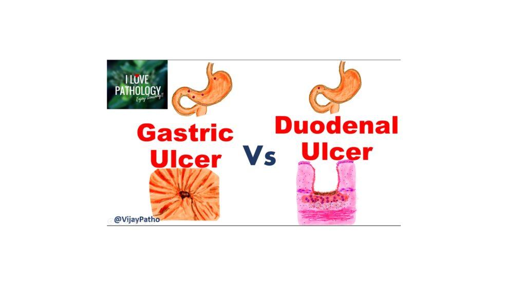 GASTRIC vs DUODENAL ULCERS - Pathology Made Simple