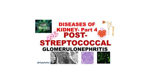 Acute Post Streptococcal Glomerulonephritis - Pathology Made Simple