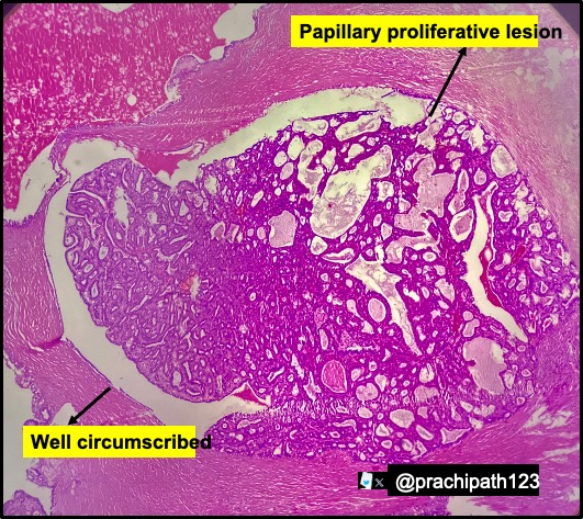 Atypical ductal hyperplasia arising in Intraductal papilloma ...