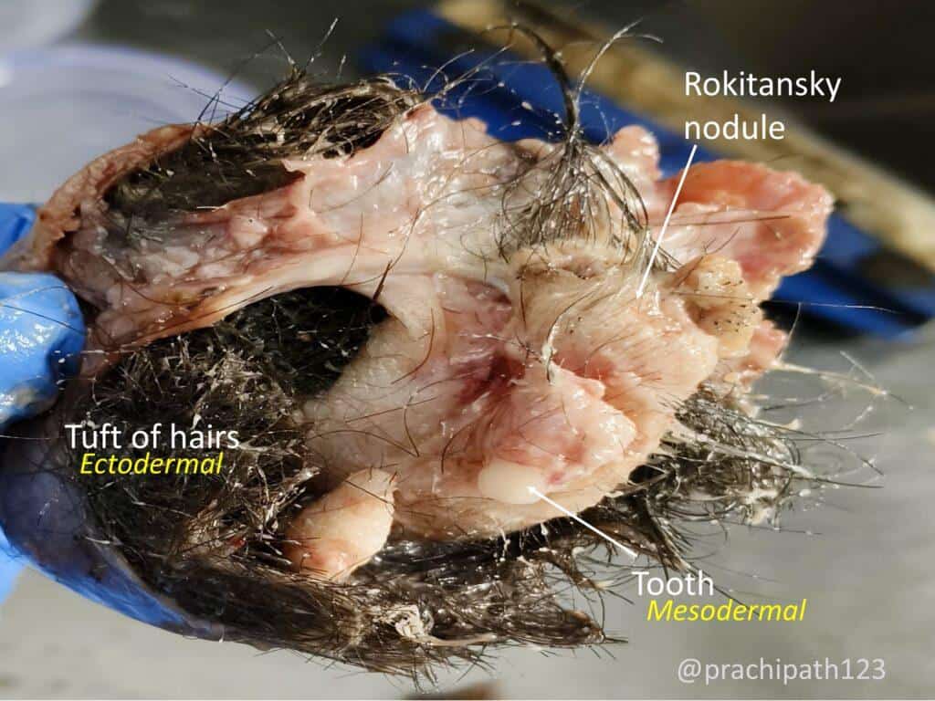 Ovarian Teratoma Pathology Made Simple Ovarian Teratoma Pathology Made Simple